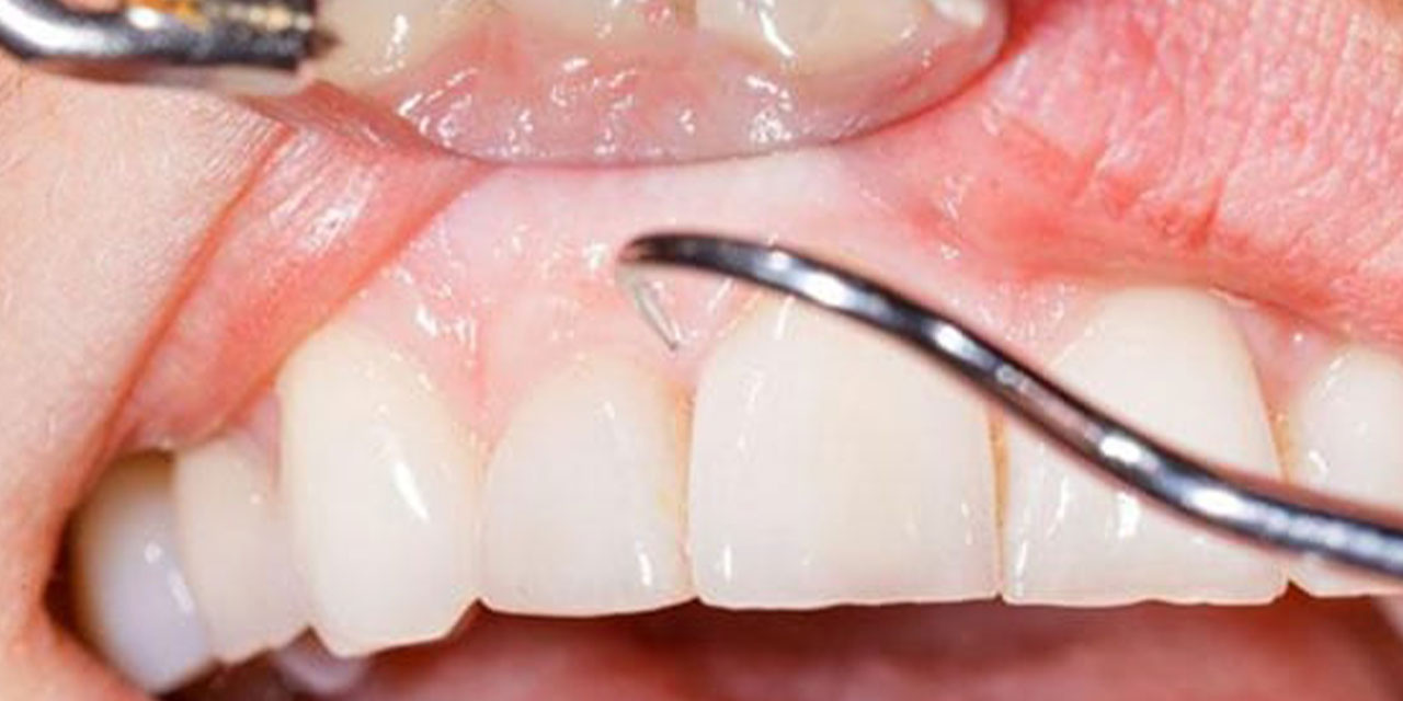 Periodontoloji nedir? Periodontoloji nasıl tedavi edilir?