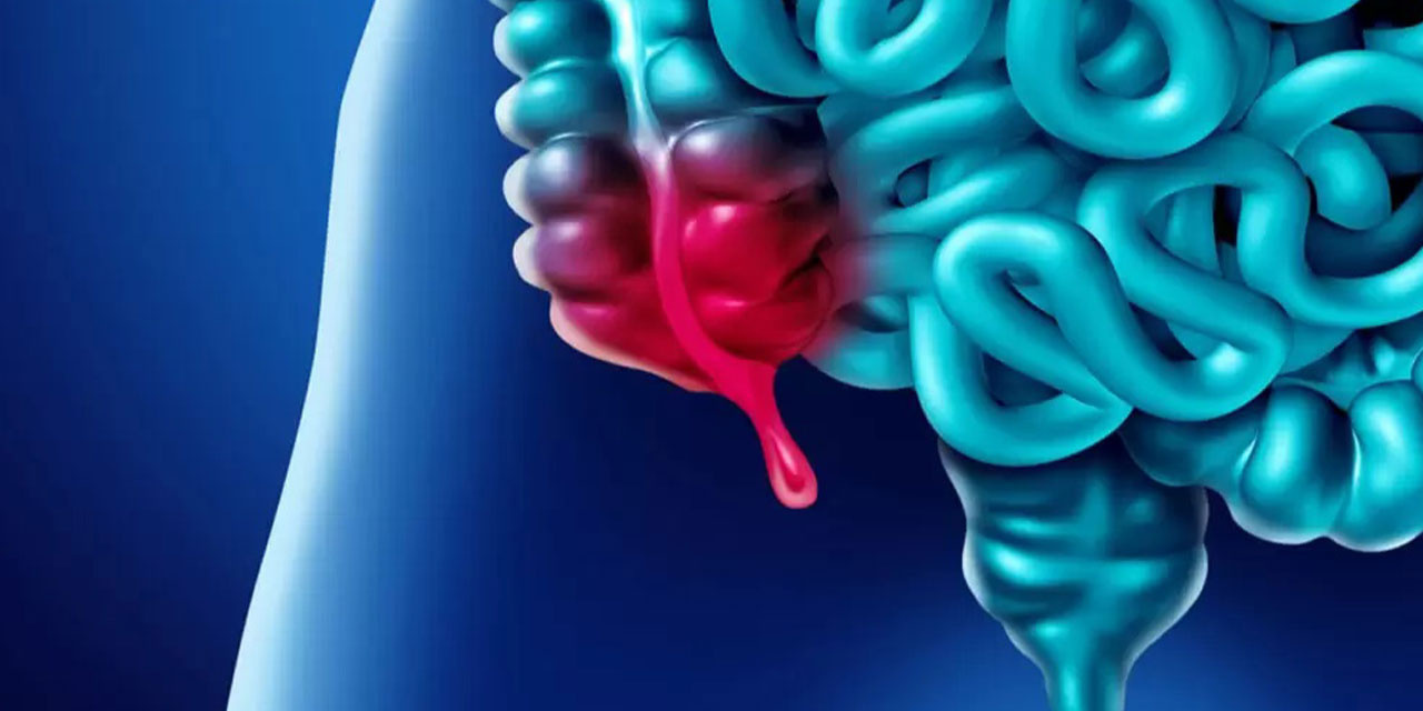 Apandisit nedir? Apandisit neden olur?